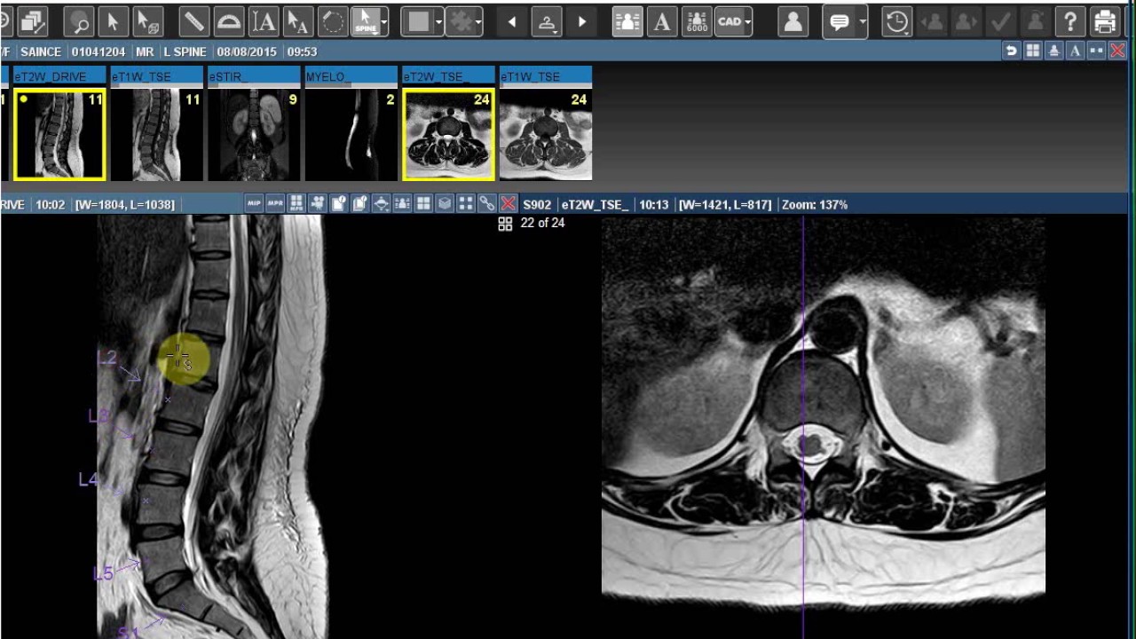 Automatic Spine Labeling - Saince Merge PACS - YouTube