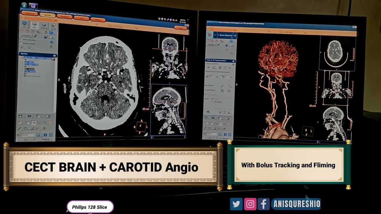 Brain + Carotid Angio with Bolus tracking and Fliming| By Anis Qureshi - YouTube