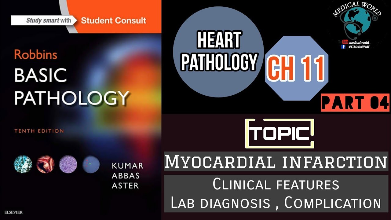 Myocardial infarction P4 | Clinical features | Lab diagnosis ...