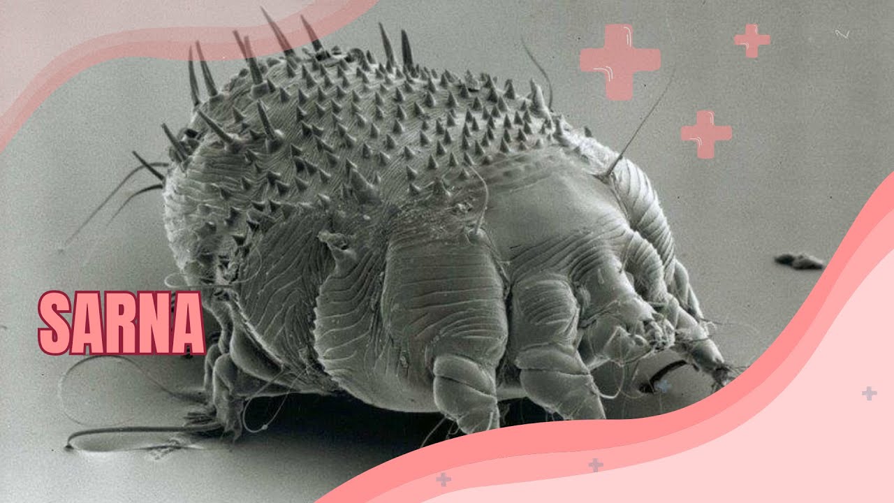 Sarna, Parasitología Virtual - YouTube