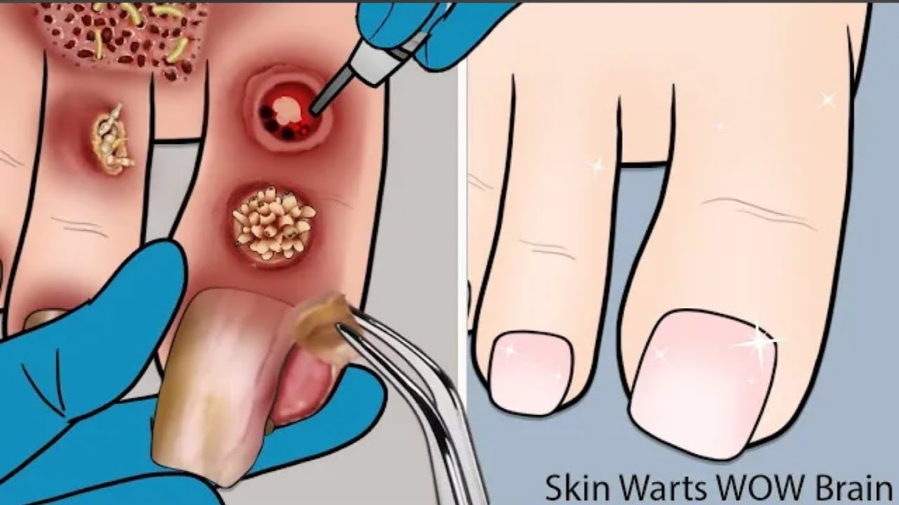 ASMR Coolness! Ingrown Toenail removal treatment animation | 4K Video ...