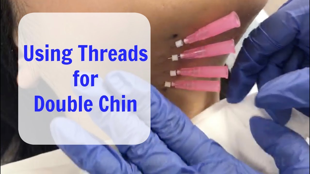 PDO threads for Double Chin - YouTube
