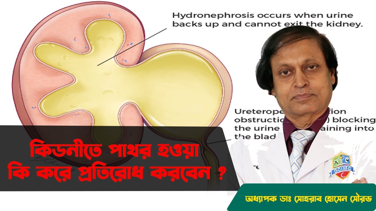 What is Pelvic Ureteric Junction (PUJ) Obstruction? Prof.Dr.Shorab ...