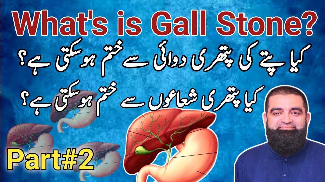 What's the Gall Stone?|| Treatment Gall Stone with Medicine ...