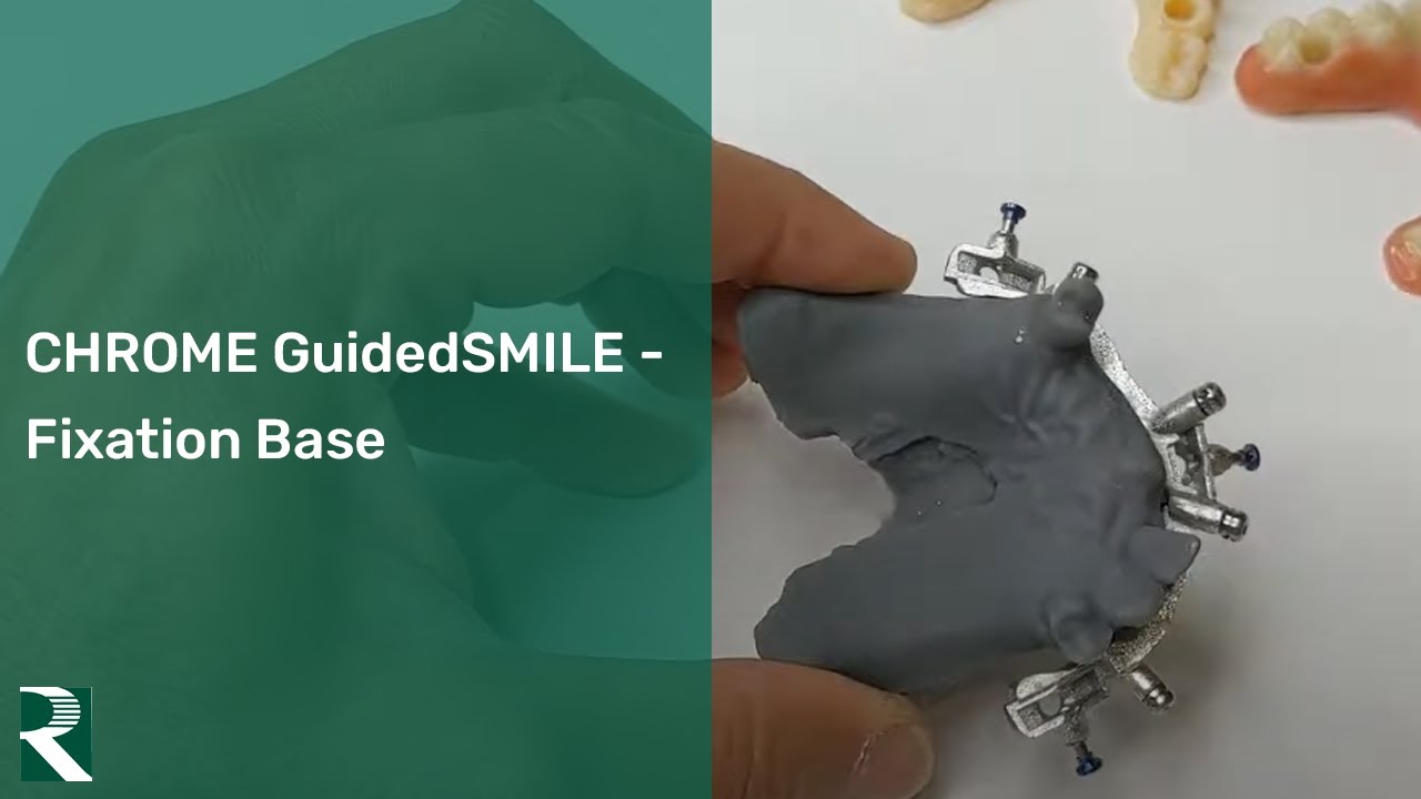 CHROME GuidedSMILE - Fixation Base - YouTube