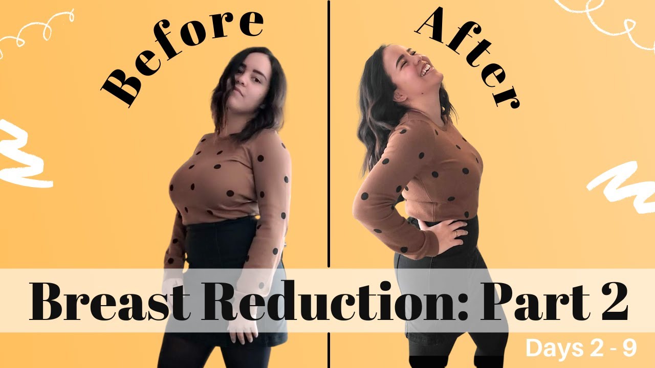 * Breast Reduction Surgery * | Post-Op Days 2-9 + Post-Op Pictures ...