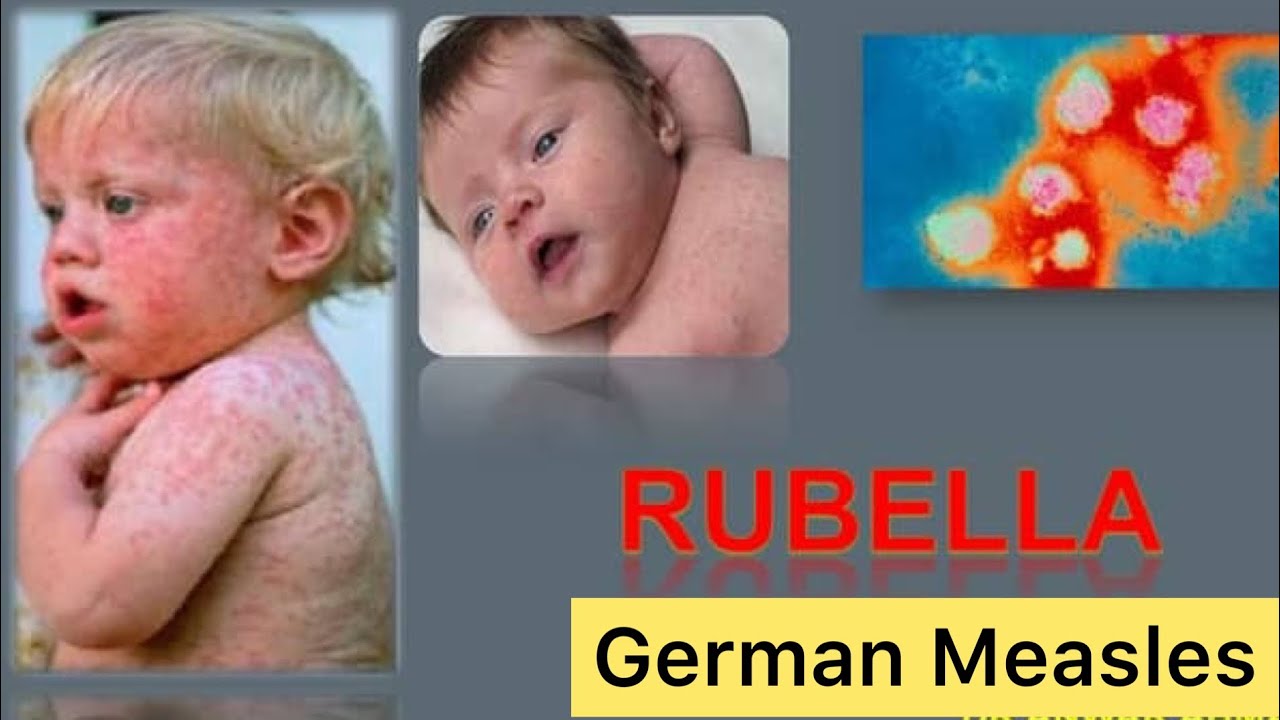 What is Rubella? (Contagious Viral Rash) German Measles || Rubella ...