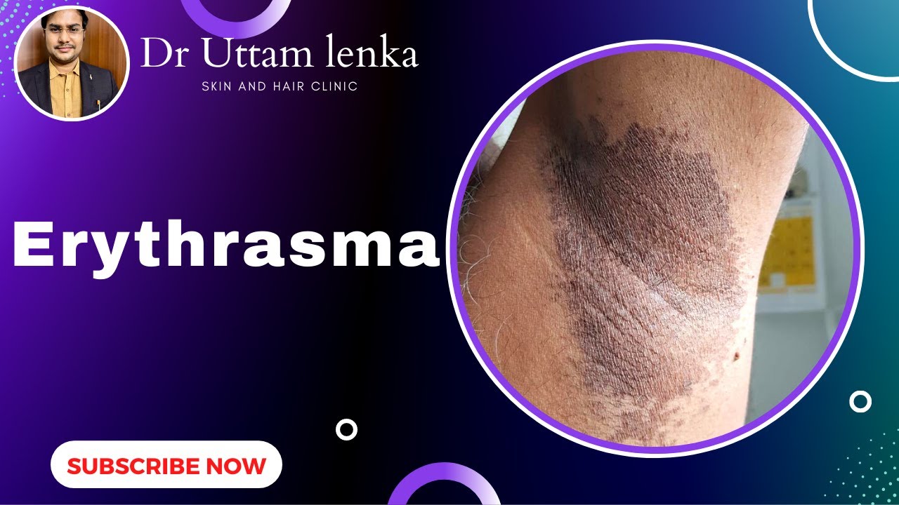 Erythrasma | Black spots in underarm , below breast, groin / बग़ल का ...