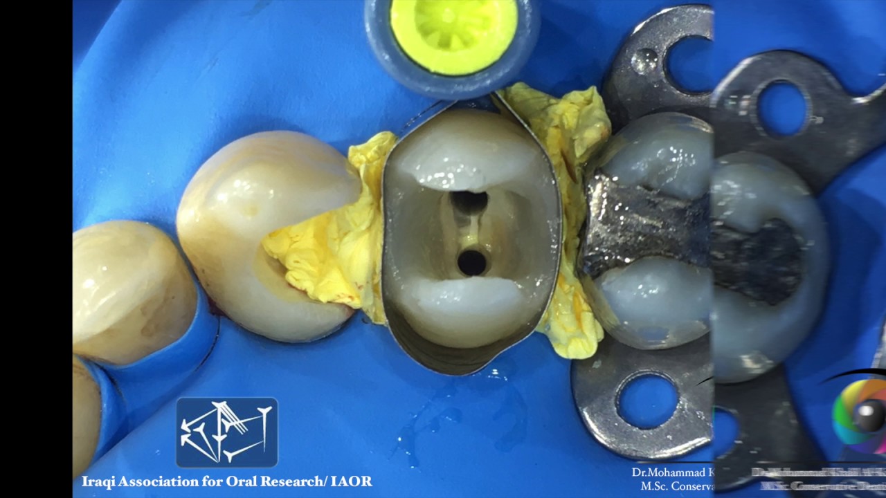 Managment of Deep Subgingival Margins of teeth 1.3 & 1.4 respectively ...