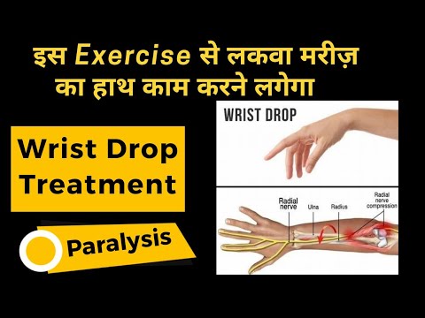 लकवा में Wrist Drop का इलाज || Wrist Drop Treatment in Stroke Patients ...
