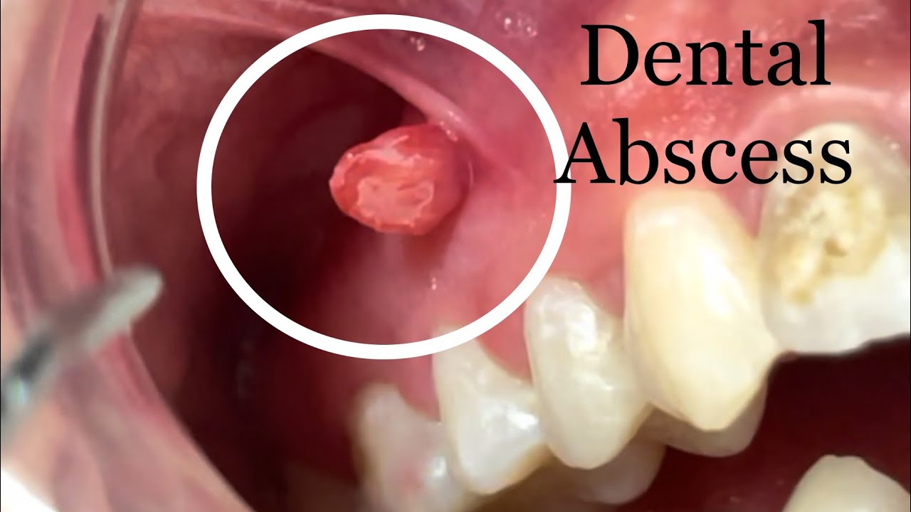 Periapical Abscess Fistula