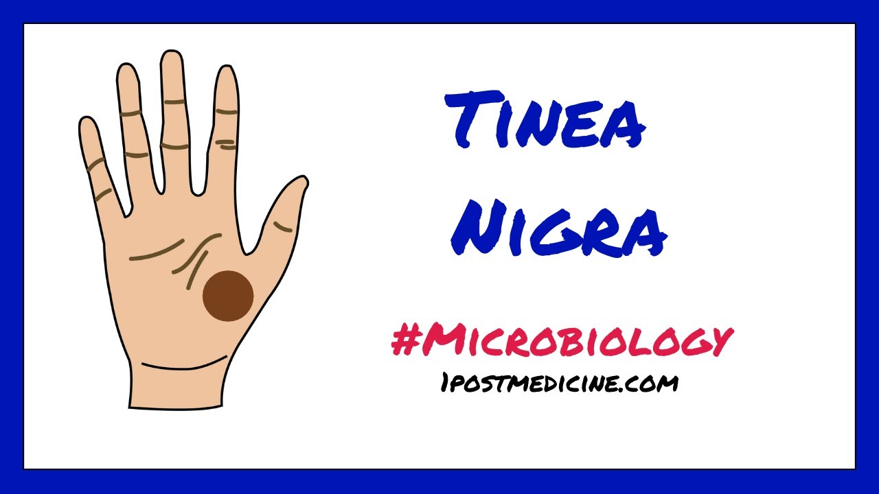 Tinea Nigra // Microbiology - YouTube