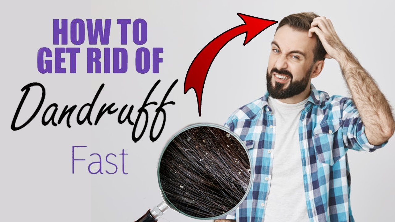 How to Get Rid of Dandruff Naturally at Home || Home Remedies for ...