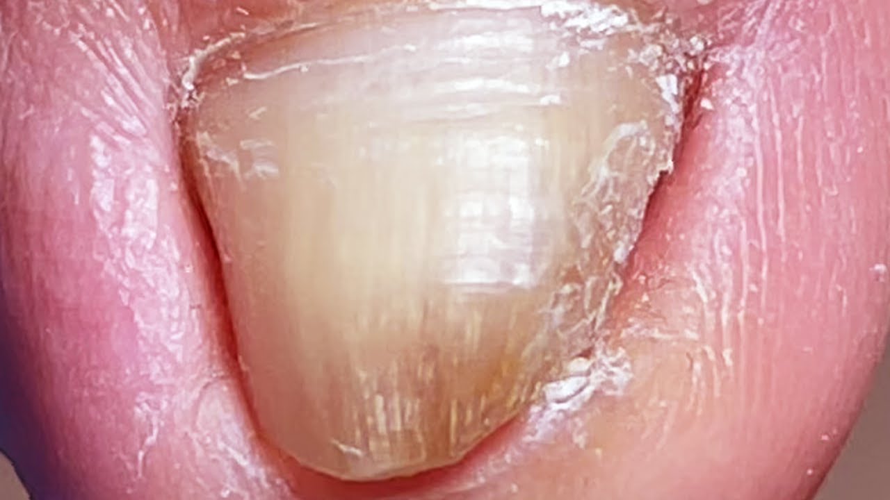 The whole process of removing ingrown nails with super thick nails ...