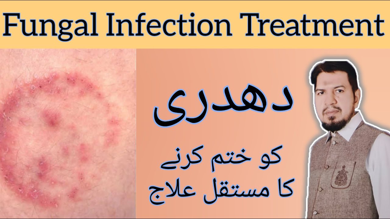 How to Remove Fungal Infection | Daad/ Dhadri Ka Illaj | Hakeem Syed ...