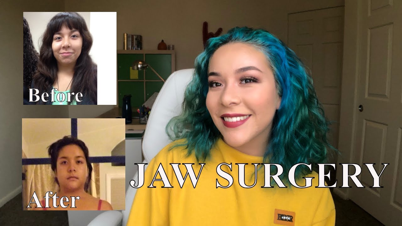 I HAD JAW SURGERY | Before & After Photos | Story Time - YouTube