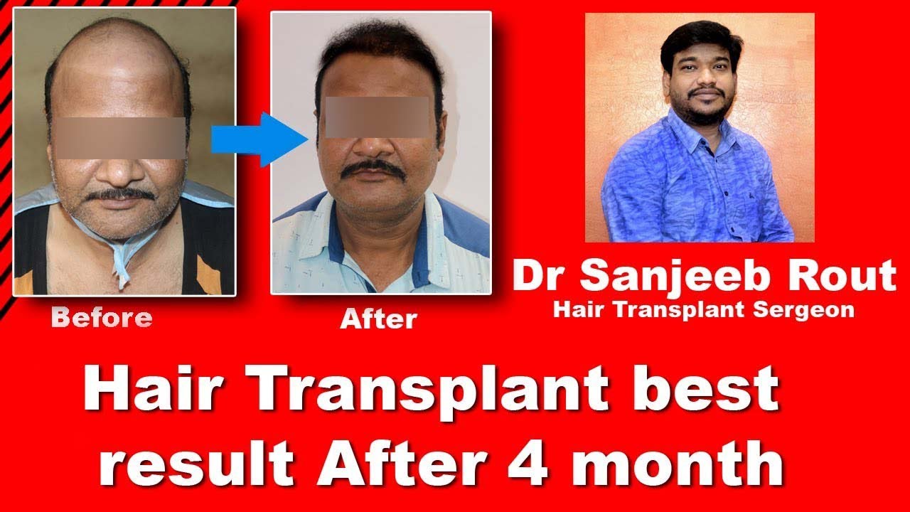 Hair Transplant Before After | Dr. Sanjeeb Rout | Balaji Skin and Hair clinic | 8895430161 - YouTube