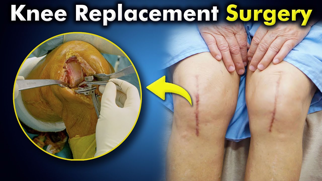 knee replacement surgery: one minute animation - YouTube
