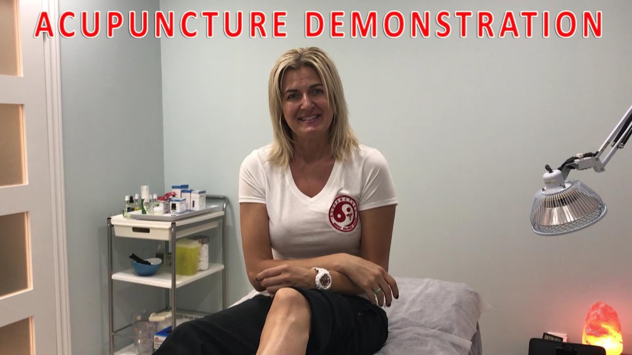 Acupuncture Demonstration - YouTube