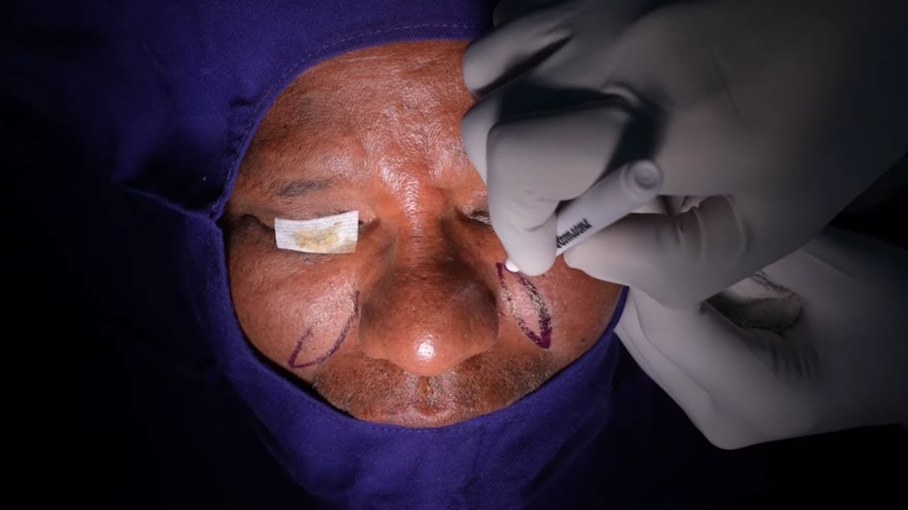 Large Scar on Face Removed by Surgery - YouTube