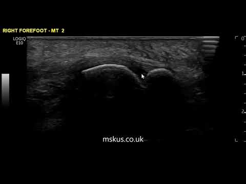 Normal Plantar Plate - YouTube