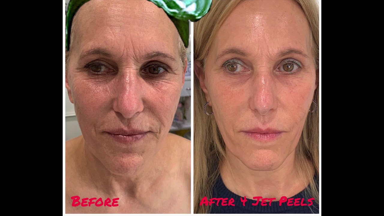 Jet Peel Technology - YouTube