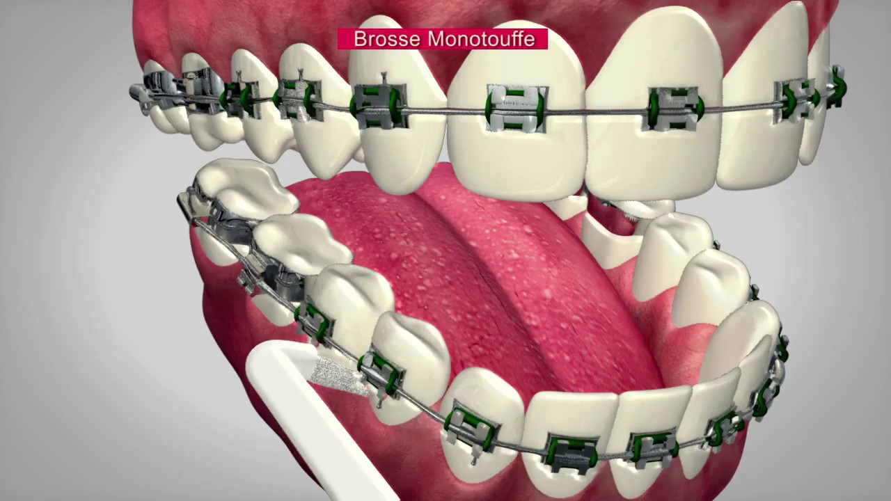 Utiliser la brosse monotouffe avec votre appareil dentaire - YouTube