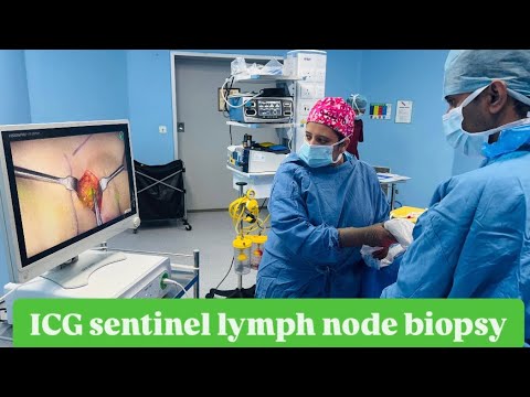 ICG sentinel axillary lymph node biopsy breast cancer surgery | latest ...