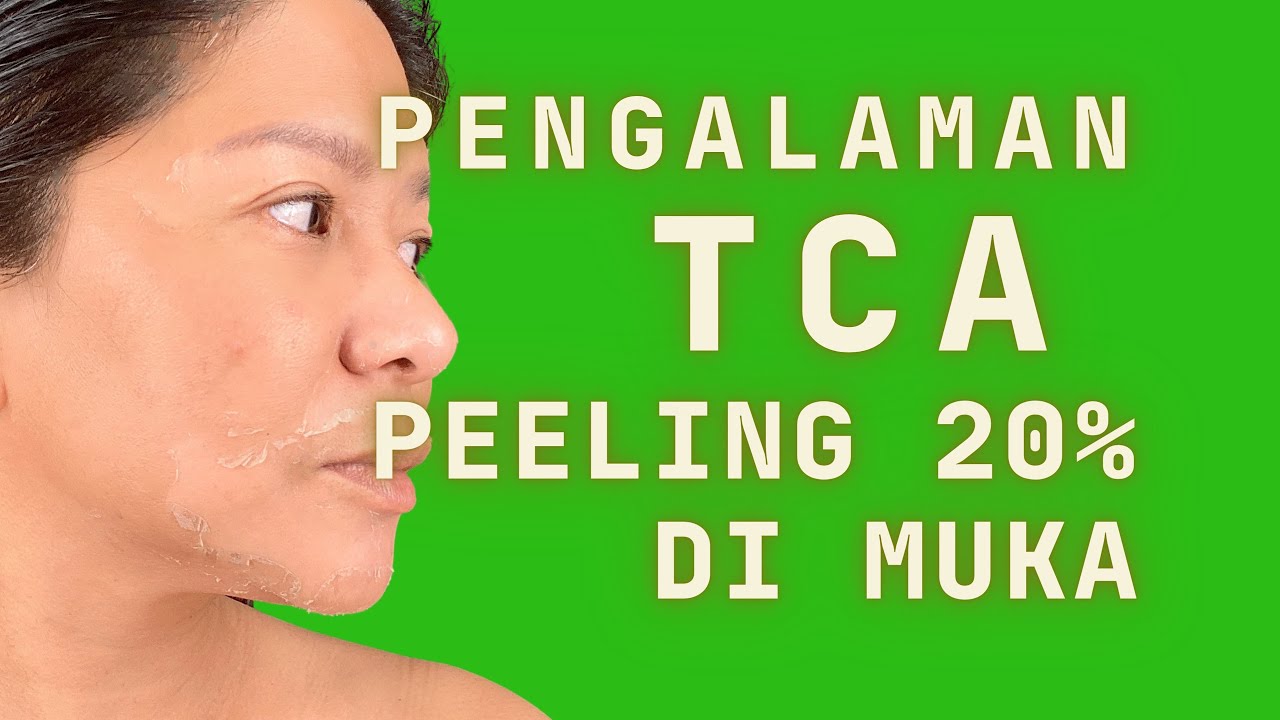 TCA PEELING 20% a.k.a Chemical Peeling MUKA - YouTube