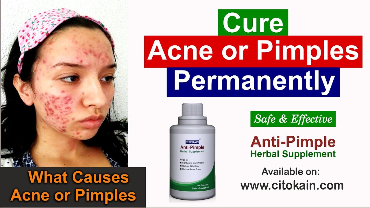 Whats Causes Acne Or Pimples Pimples Treatment Anti Pimples
