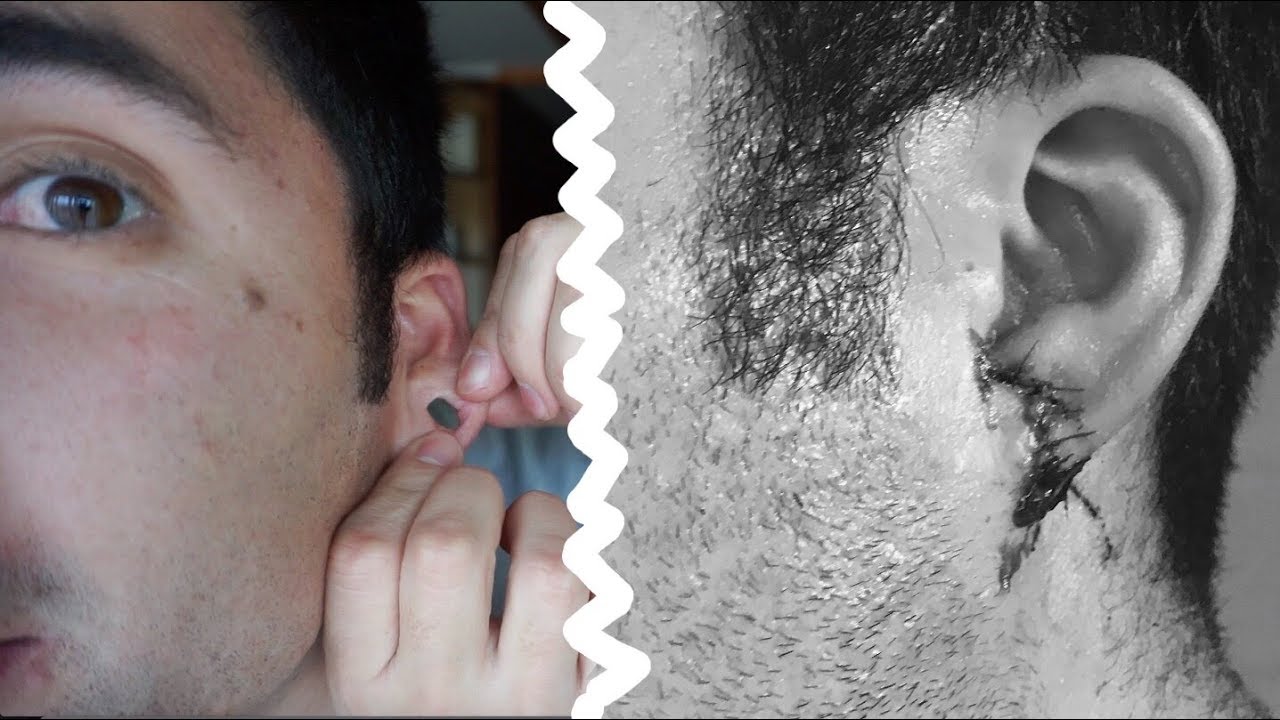 Reconstrucción de lóbulo... ADIOS expansión/dilatación - YouTube