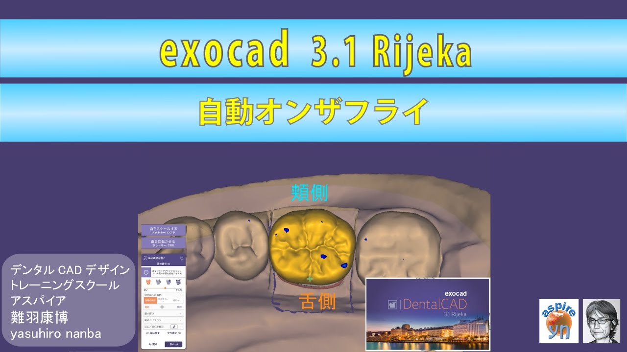 exocad 3.1 Rijeka 臼歯単冠 自動オンザフライ変形 - YouTube