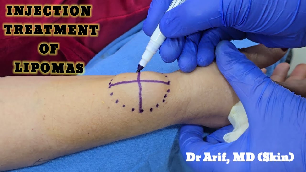 Injection treatment of lipoma @DrArifMDDermatologist - YouTube