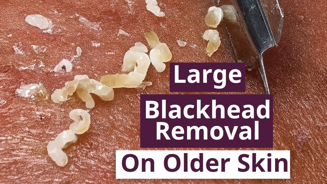 Satisfying Large Blackhead Extraction on Older Skin – Pimple Popping ...