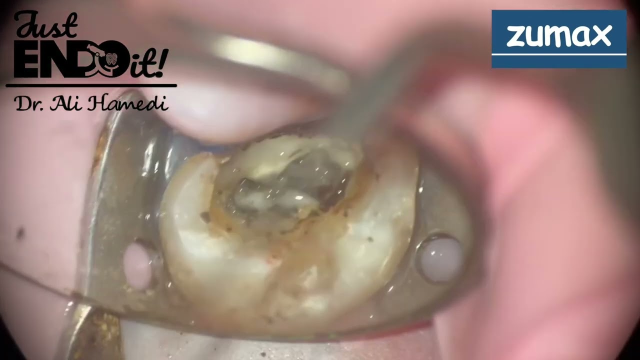 Pulp stone removal - YouTube