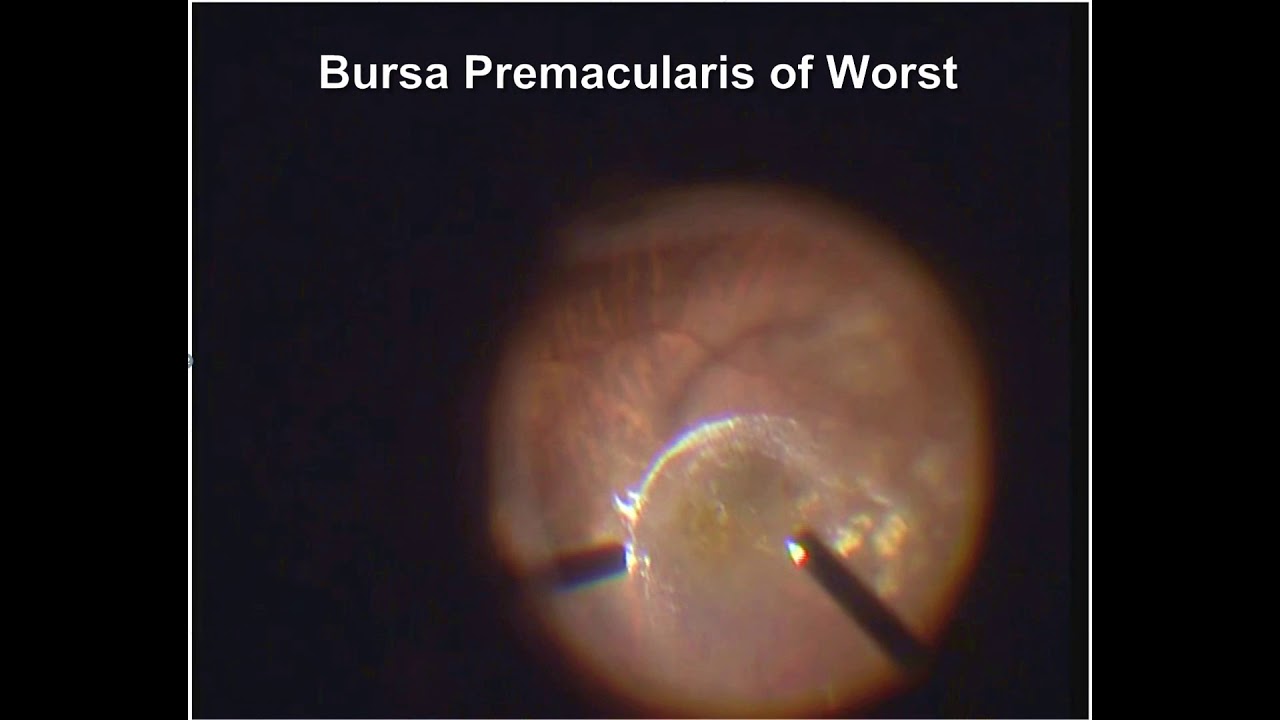 Bursa premacularis or the Posterior Precortical Vitreous Pocket - YouTube