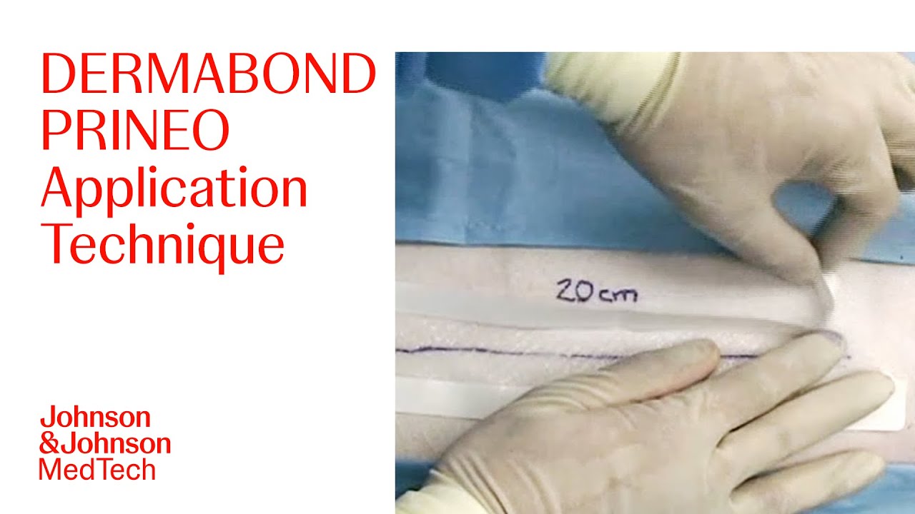 DERMABOND PRINEO Application Technique Demonstration | J&J MedTech ...