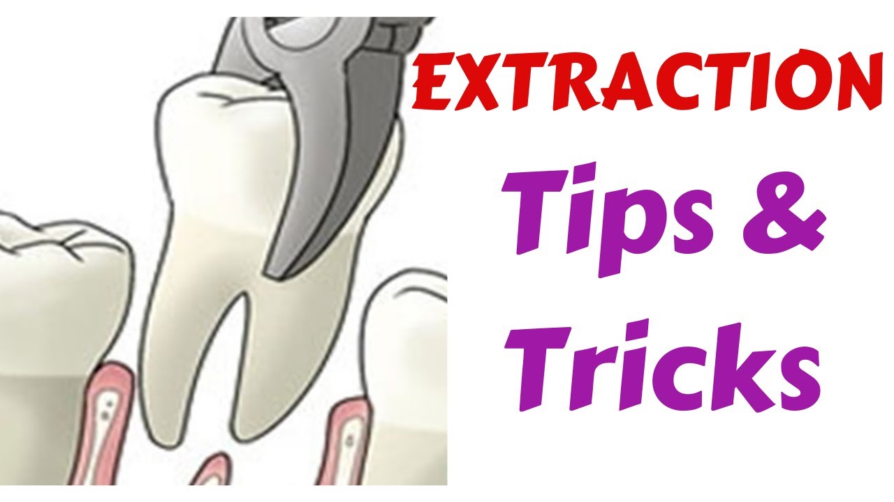 Exodontia Tips & Tricks - Diagnosis & Treatment Panning || Indication ...