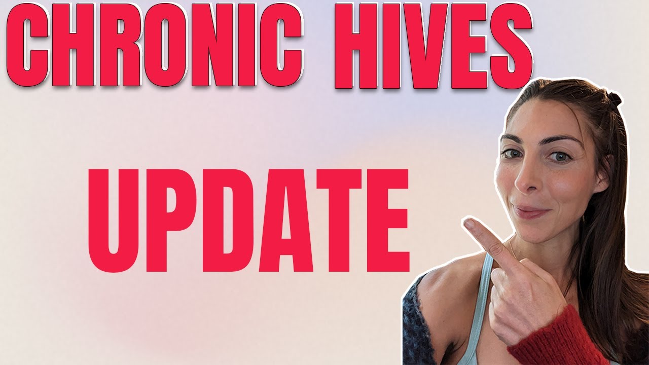 Chronic Hives Weekly Update: H. Pylori Bacteria the Root Cause? - YouTube