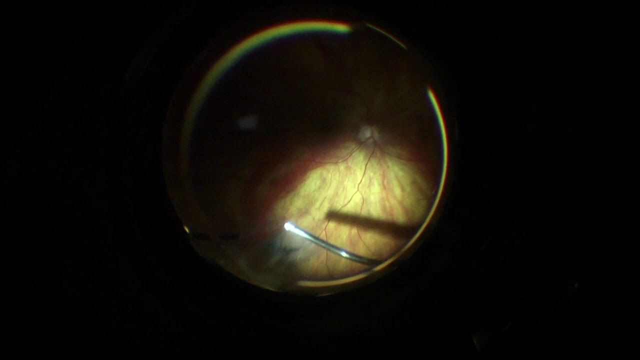 27G refractive phacovitrectomy for floaters with ICL removal - YouTube