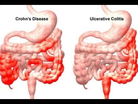 Ulcerative colitis Symptoms - Causes, Signs and Symptoms of Ulcerative ...