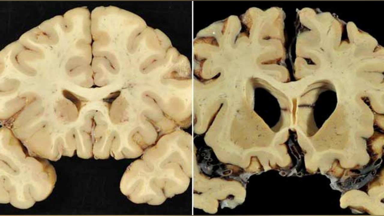 Chris Benoit Brain Damage