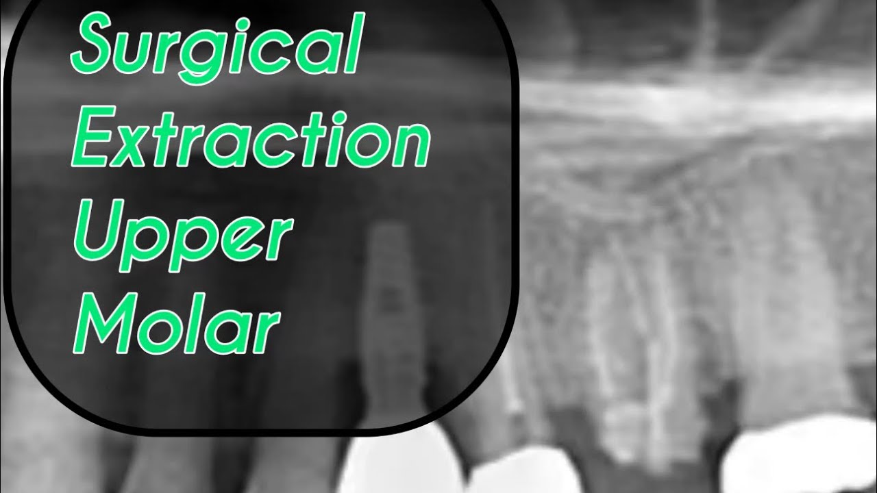 Surgical Extraction Upper Molar - YouTube
