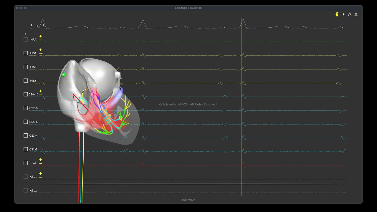 Epicardio Simulation™ Cardiac EP Introduction - YouTube