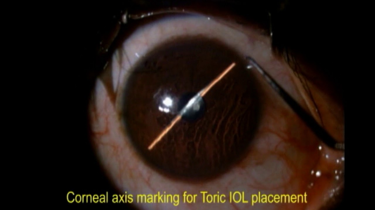 AIOC2018 - VT213 - Comparision of Axis Marking in Toric IOLs – Slit ...