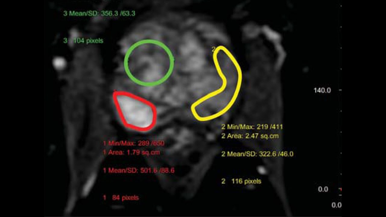 Biópsia transperineal de próstata com fusão de imagens - YouTube