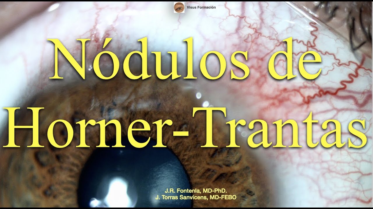 Nódulos de Horner-Trantas. Queratoconjuntivits Vernal. - YouTube
