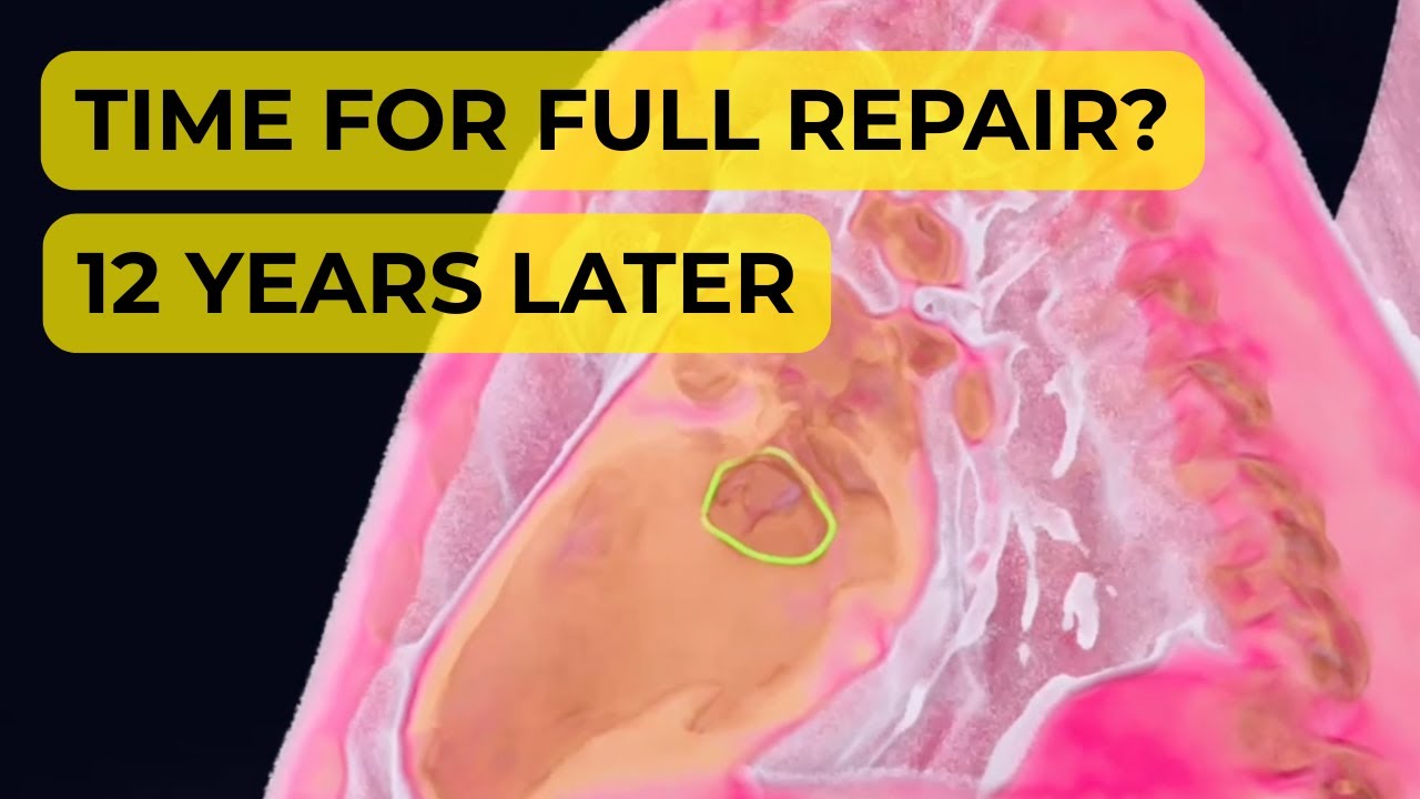 DORV with Perimembranous VSD. S/p PA banding – Baffle Repair By Dr ...