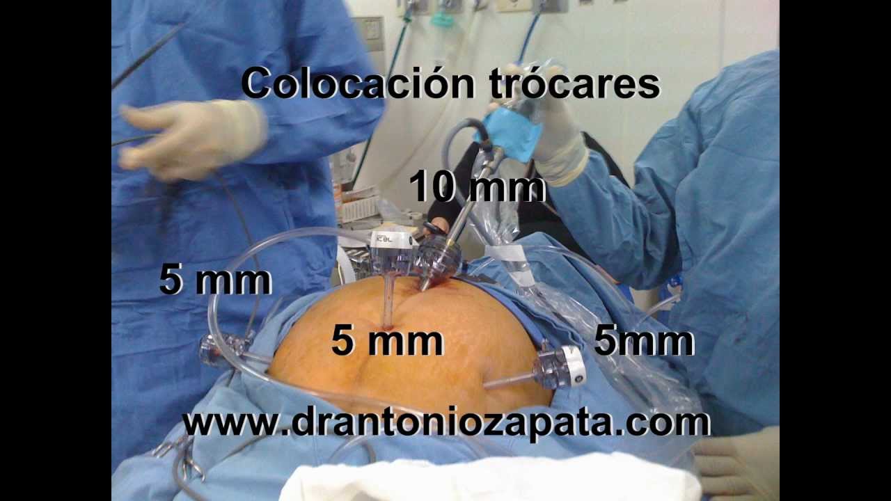 Colposuspension laparoscopica procedimiento de Burch - YouTube