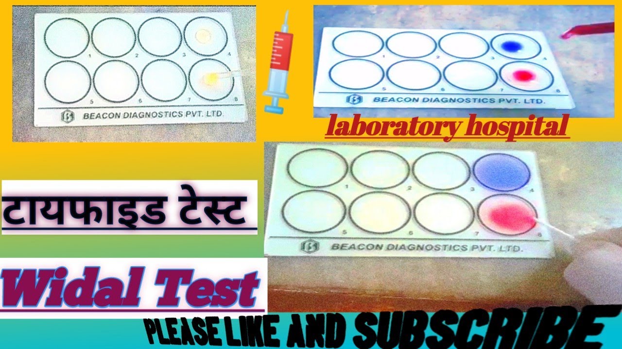 Widal Test Practical | Qualitative WidalTest | Quantitative Widal Test ...